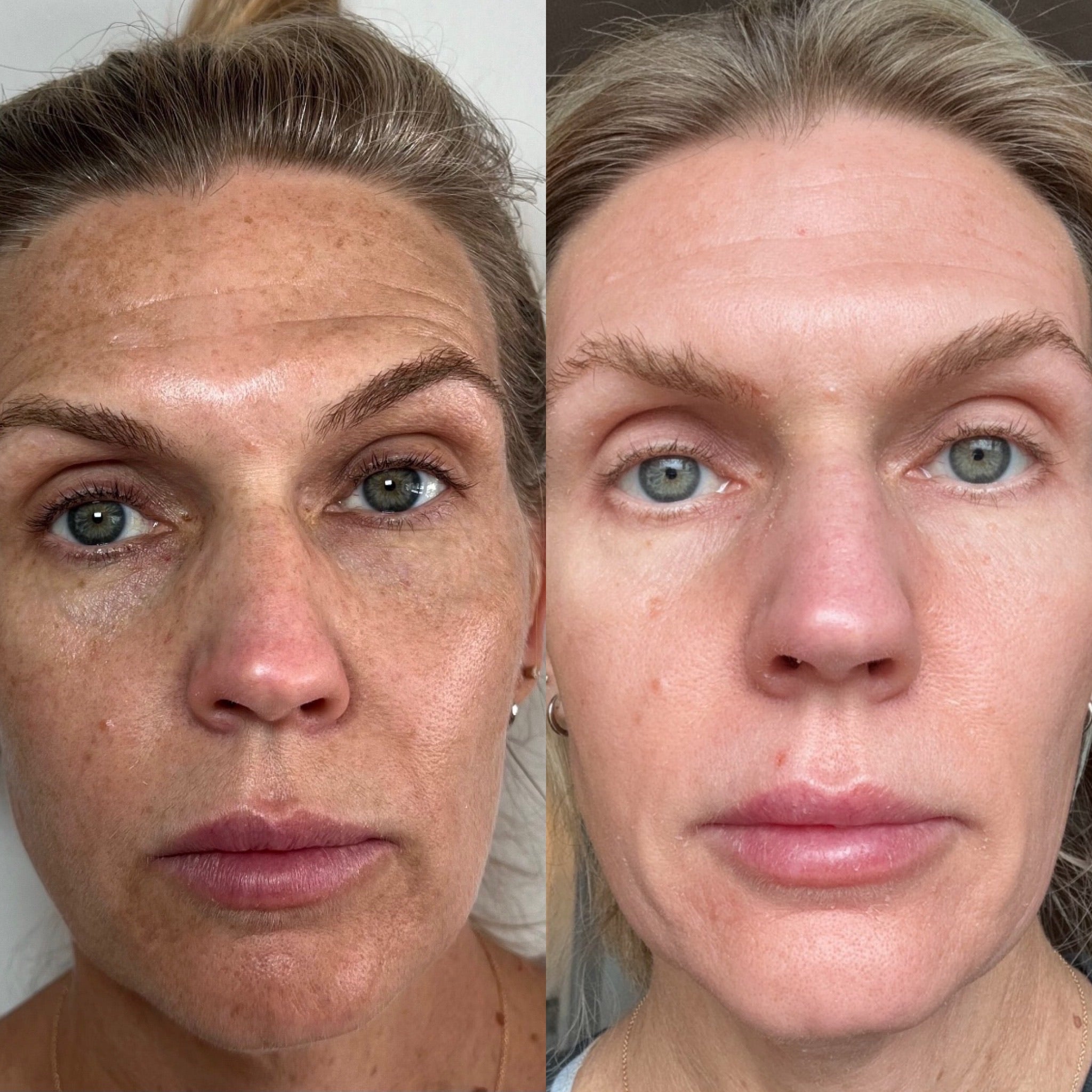 Melasma vs. Sun Damage: Why They’re Not the Same (and How to Treat It ...